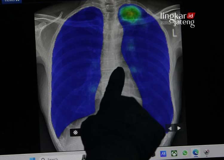 Waspada! Sudah 10 Orang Meninggal karena TBC di Grobogan, Masyarakat ...